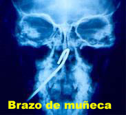 CUERPOS EXTRAÑOS EN ORL