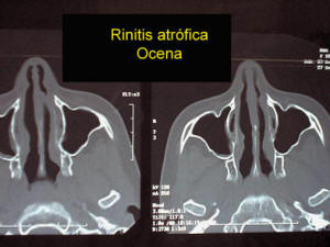 Ocena rinitis atrófica
